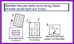 My Review: Provent Skin Tag Remover (2025) – Does It Work? - Supplementox